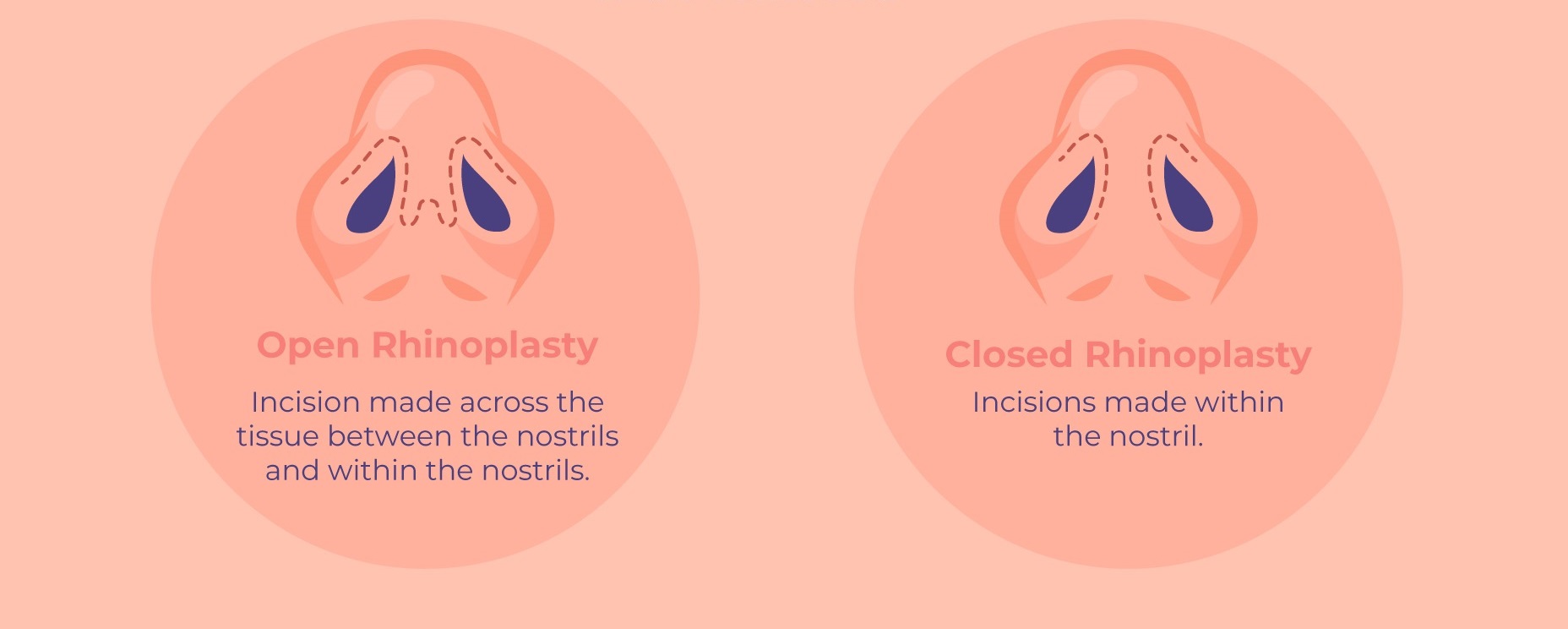 Open vs Closed Rhinoplasty: Key Differences Explained