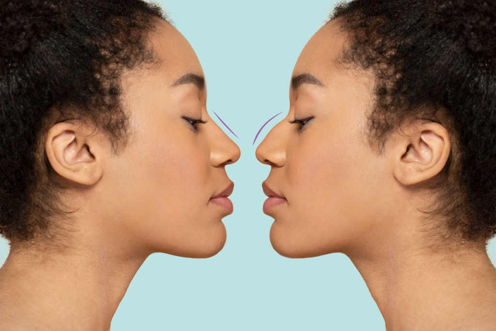 Revision Rhinoplasty: Correcting Previous Surgery